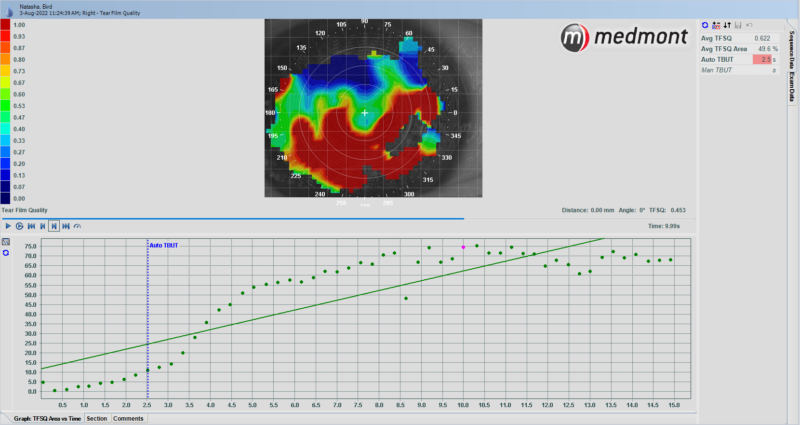 The Soft Lens Dropout Patient – Part 1 - Contamac