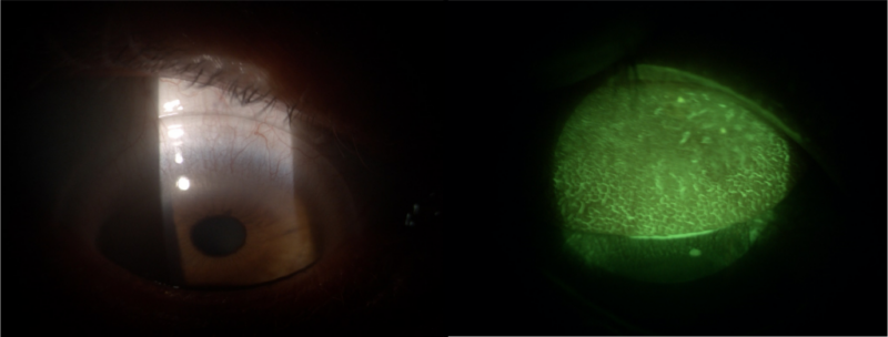 The Hard Facts on GP Contact Lens Care - Contamac