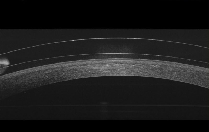 Slit Lamp Series – Oblate Cornea - Contamac