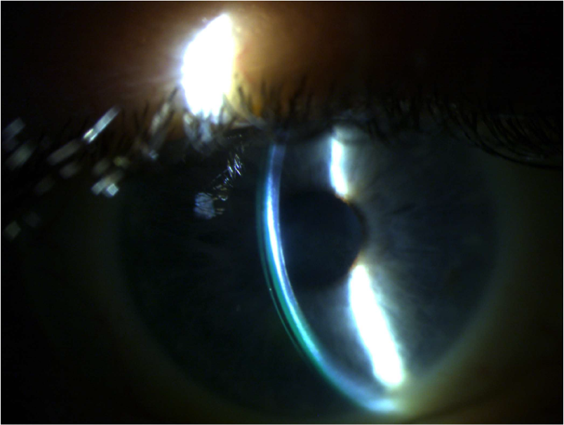 Reclaiming Vision: Scleral Lens Fitting After Acanthamoeba Infection ...